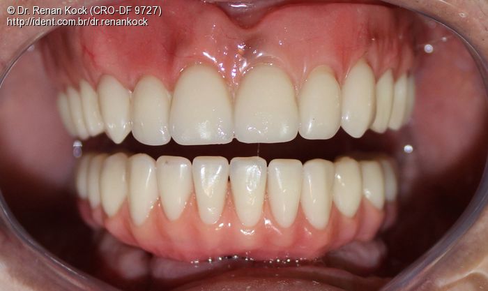 Protocolo Inferior Imediato, Caso clínico | iDent