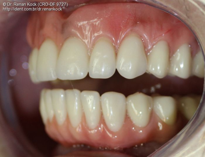 Protocolo Inferior Imediato, Caso clínico | iDent