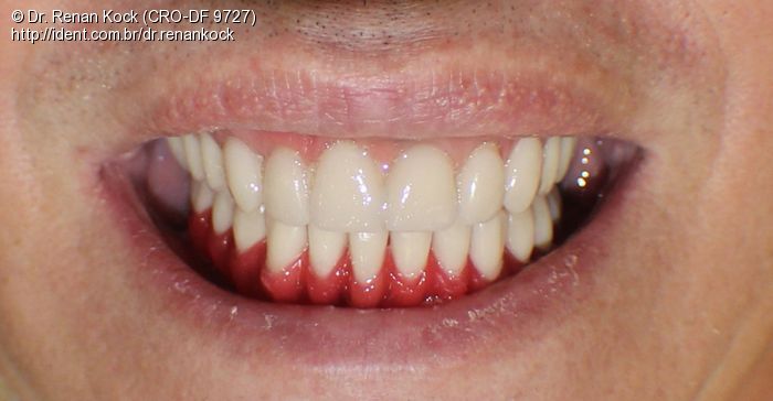 Protocolo Inferior Imediato, Caso clínico | iDent