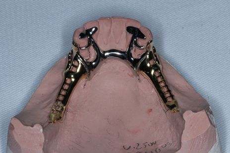 Prótese Total e Parcial Removível na Reabilitação de um Paciente com ...