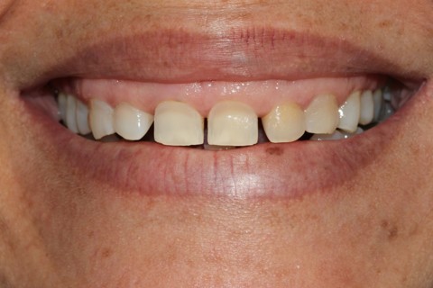 Tratamento Endodôntico Dente 26 com Calcificação dos Condutos ...