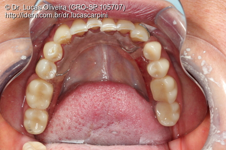 Troca de Próteses Parciais Removíveis, Caso clínico | iDent