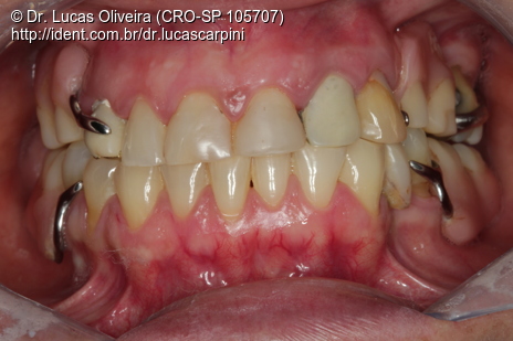 Troca de Próteses Parciais Removíveis, Caso clínico | iDent