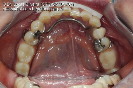 Troca de Próteses Parciais Removíveis, Caso clínico | iDent